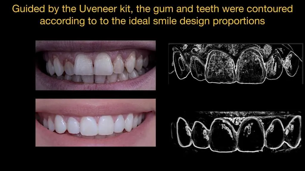 Uveneers: Composite Veneers Melbourne | Dr Sigal Jacobson